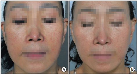 HIFU& Clinical Effectiveness of a HIFU in Skin Lifting| Article | AFA